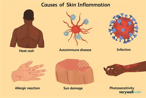 How To Stop Rubbing Your Body Up The Wrong Way In The Heat Bad Skin