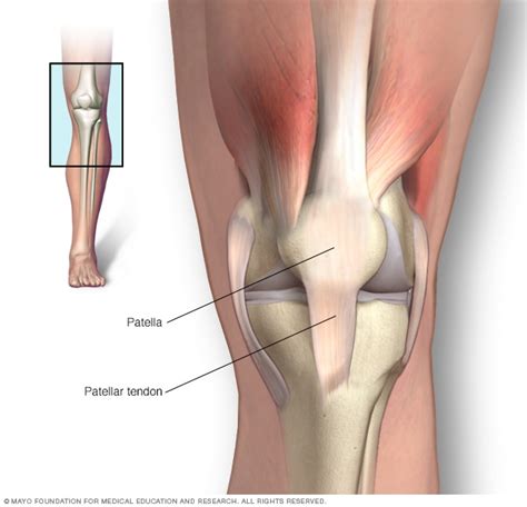 Tendinitis rotuliana Síntomas y causas Mayo Clinic