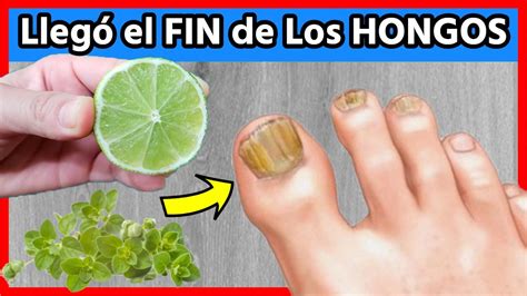 Por Fin Encontré la Solución Más Rápida para Eliminar Los Hongos en Las