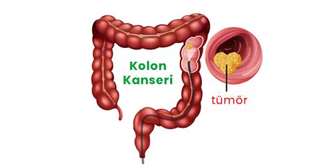 Kolon Kanseri Neden Olur Belirtileri Tedavi Y Ntemleri Ve Ameliyat