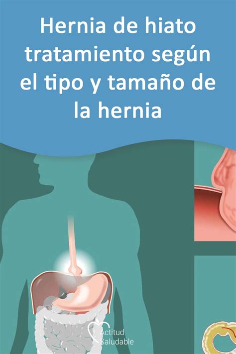 Hernia de hiato tratamiento según el tipo y tamaño de la hernia