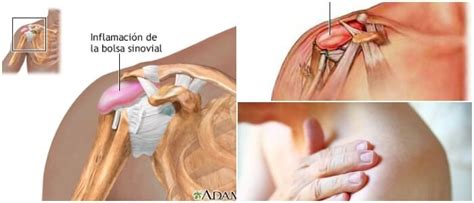 Bursitis de Hombro Causas Síntomas Diagnóstico y Tratamiento