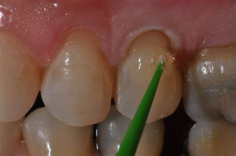 M Vestphal Odontologia Estética Restauração Classe V Resina