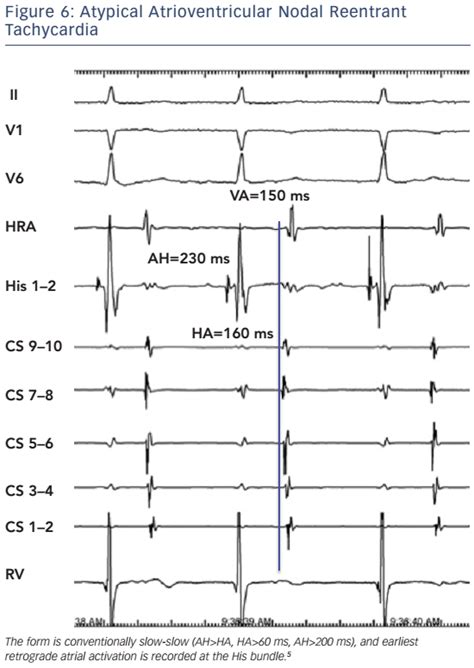 Figure 6 Atypical Atrioventricular Nodal Reentrant Tachycardia