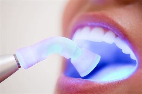 Qué es un empaste dental y para qué sirve Castro Ferreiro