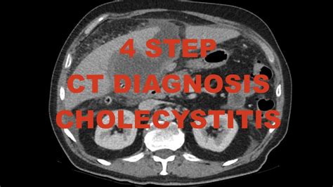 4 Step Diagnosis Acute Cholecystitis On CT Scan Case Review With