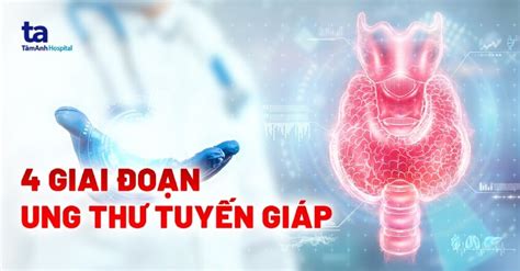 4 giai đoạn ung thư tuyến giáp Cách đánh giá và chẩn đoán