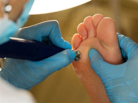 Callos en los Pies Causas Tipos Tratamientos y Prevención