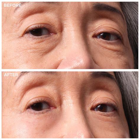 Share 81 Under Eye Bags Treatment Latest In Cdgdbentre
