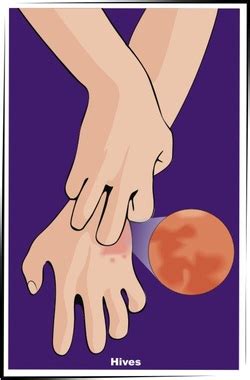 Why Urticaria Treatments Are Not As Simple As We D Want Them To Be