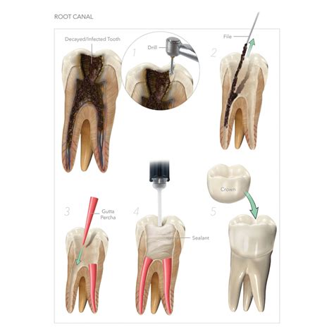 Root Canals Boston Dental