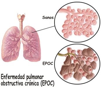 EPOC Enfermedad Pulmonar Obstructiva Crónica EPOC