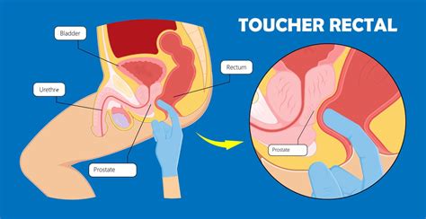 Cancer du rectum âge symptômes pronostic traitement