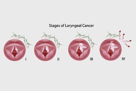 Throat Cancer Types Causes Symptoms Diagnosis And Treatments