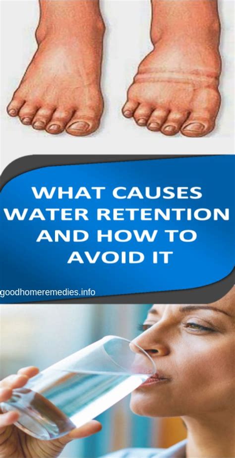 Retaining Water In Legs Symptoms