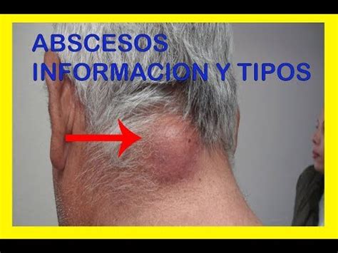 Absceso Que Es Drenaje Dental Perianal Imprescindible YouTube