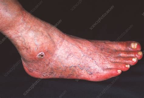 Arterial Ulcer Stock Image M Science Photo Library