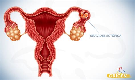 Gravidez ectópica o que é sintomas tratamento e riscos Saude e Vida