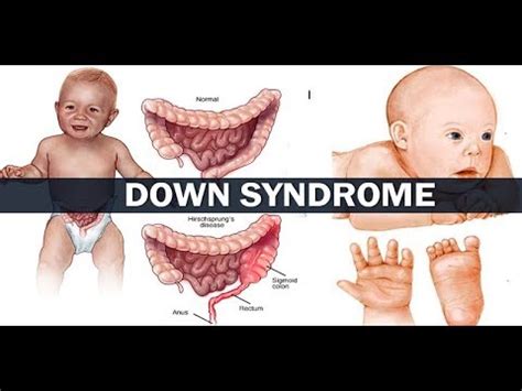 Down Syndrome Symptoms Causes Types Life Expectancy Best