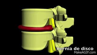 Hérnia de disco animação 3D on Make a