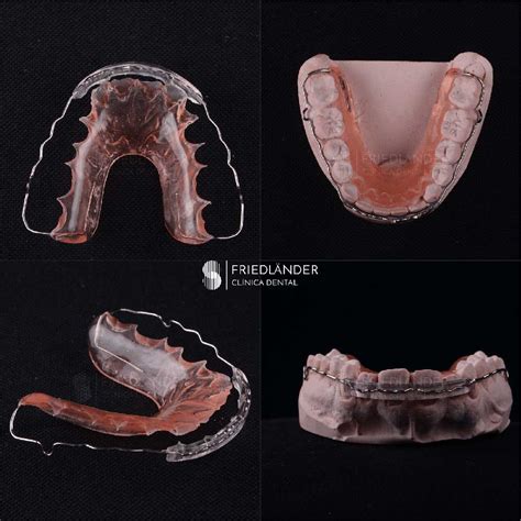 Retenedores fijos dentales La retención fija en ortodoncia