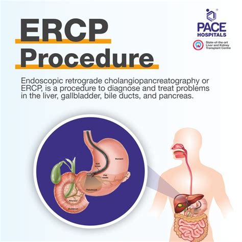 Ercp Procedure Indications Recovery Complications Hot Sex Picture