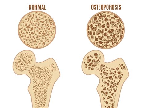 What Is Osteoporosis Know The Signs And Risks