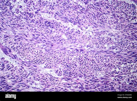 Photomicrograph Of Leiomyoma Illustrating Benign Smooth Muscle Tumor