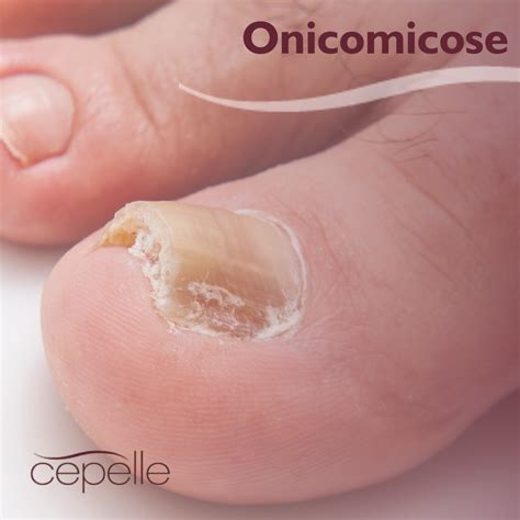 Onicomicose Cepelle Dermatologia Curitiba