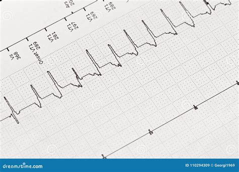 Electrocardiogram With Cardiac Arrhythmia Patient With Atrial