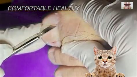 Ingrown Toenail And Impacted Toenail Relief And Prevention
