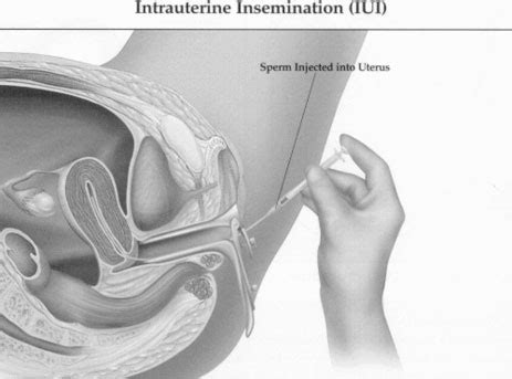 Basic Infertility Therapy Institute For Reproductive Health
