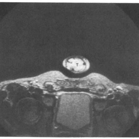 Pdf Magnetic Resonance Imaging Of Penile Rhabdomyosarcoma