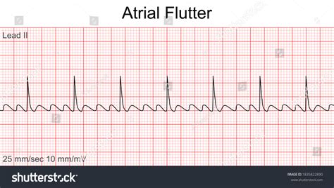 Will Atrial Flutter Show Up On Ecg Printable Templates Protal