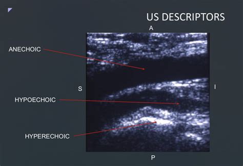 Ultrasound Labs Exam Flashcards Quizlet