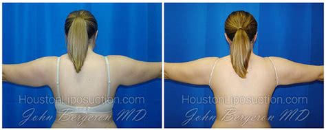 Arms Liposuction Houston Lipo Center
