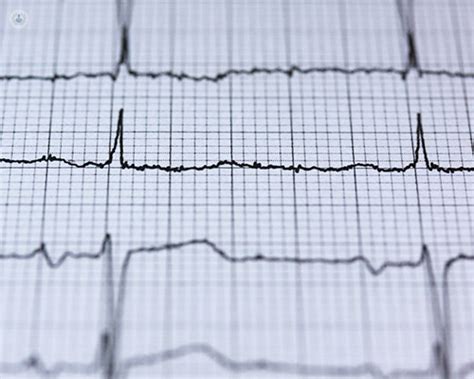 Cuándo sale mal un electrocardiograma Haras Dadinco