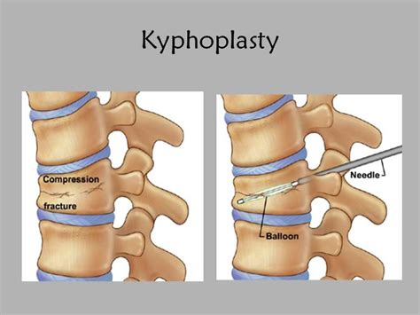 Kyphoplasty