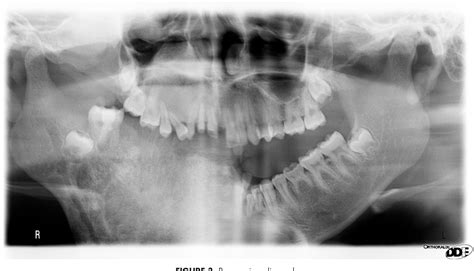 Figure 5 From Surgical Treatment Of Giant Fibrous Dysplasia Of The