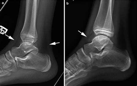 Normal Pediatric Ankle Xray