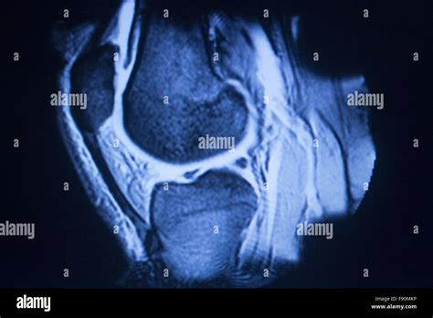 Resonancia magnética MRI exploración médica mostrando los resultados de