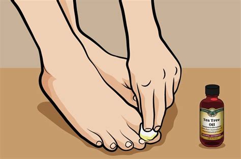 Steps On How To Get Rid Of An Ingrown Toenail Without Surgery DIY