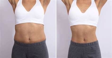 HIFU Before And After Photos London Premier Laser Skin Clinic