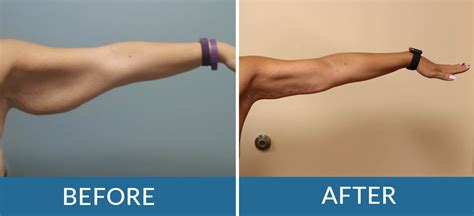 Brachioplasty Arm Lift Brain Spine Surgeons Of New York