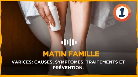 Varices Causes symptômes traitements et prévention YouTube