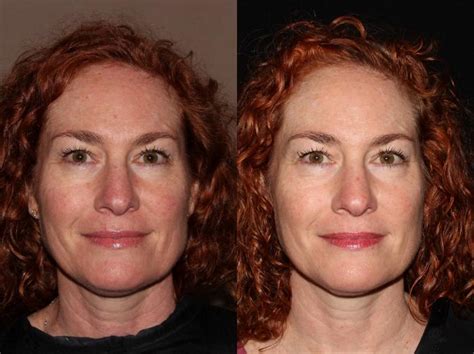 BBL PhotoFacial Before And After Photo Gallery Chico Yuba City
