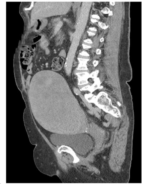 Ct Scan Pelvis Label
