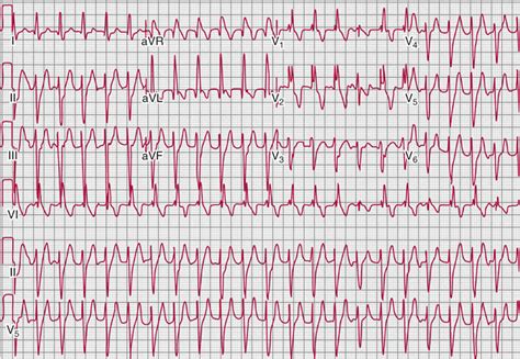Ventricular Tachycardia Causes Symptoms Diagnosis Prognosis Treatment
