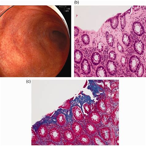 A Colonoscopic Image Obtained July Showing A Normal Mucosa B