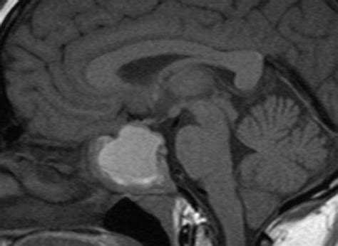 Radiology Of The Pituitary Endotext NCBI Bookshelf
